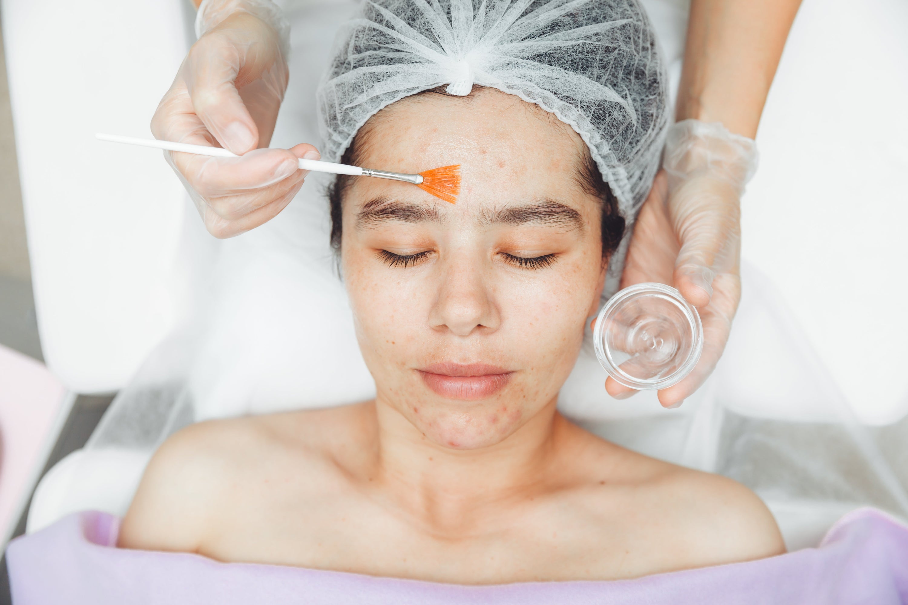 Ultimate Guide to Chemical Peels: Benefits, Types, and Recovery Tips ...