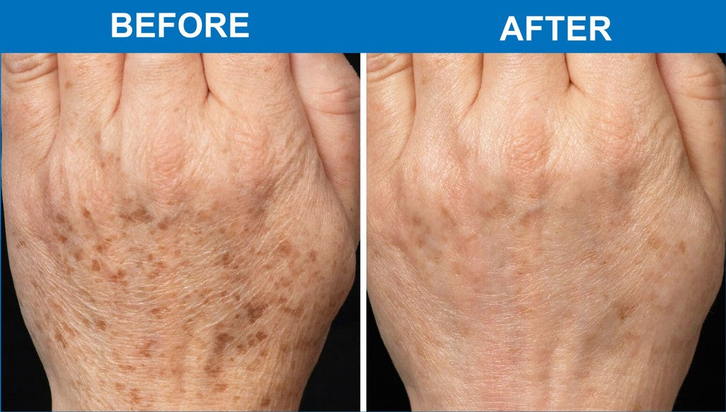 Revitalizing TCA Skin Peel: Customize Your Strength from 10% to 30% ...